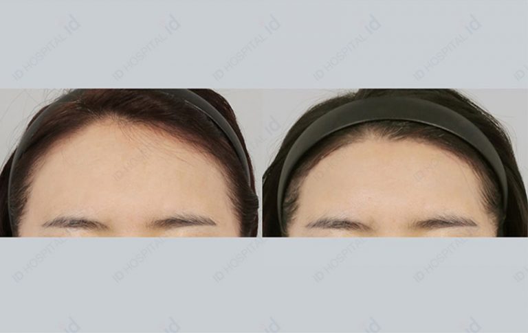 Why is the forehead reduction surgery trending? - IDHOSPITAL
