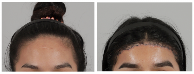 Why is the forehead reduction surgery trending? - IDHOSPITAL