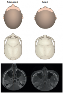 Why are facial contouring surgeries popular in Asia? - IDHOSPITAL