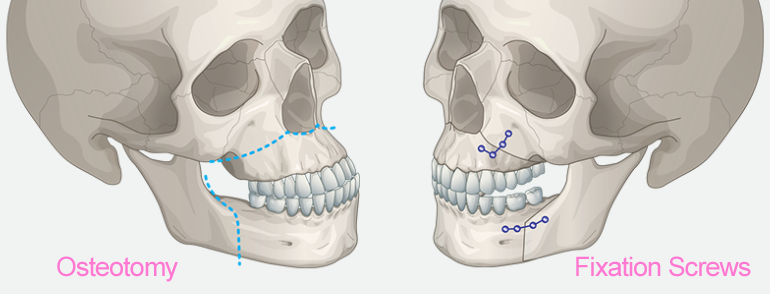Ask ID Doctors: Facial bone surgeries - IDHOSPITAL