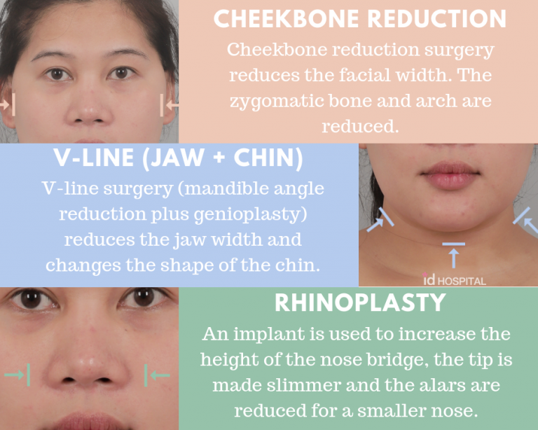 Gabbie's 6 months post-surgery FFS results at ID Hospital