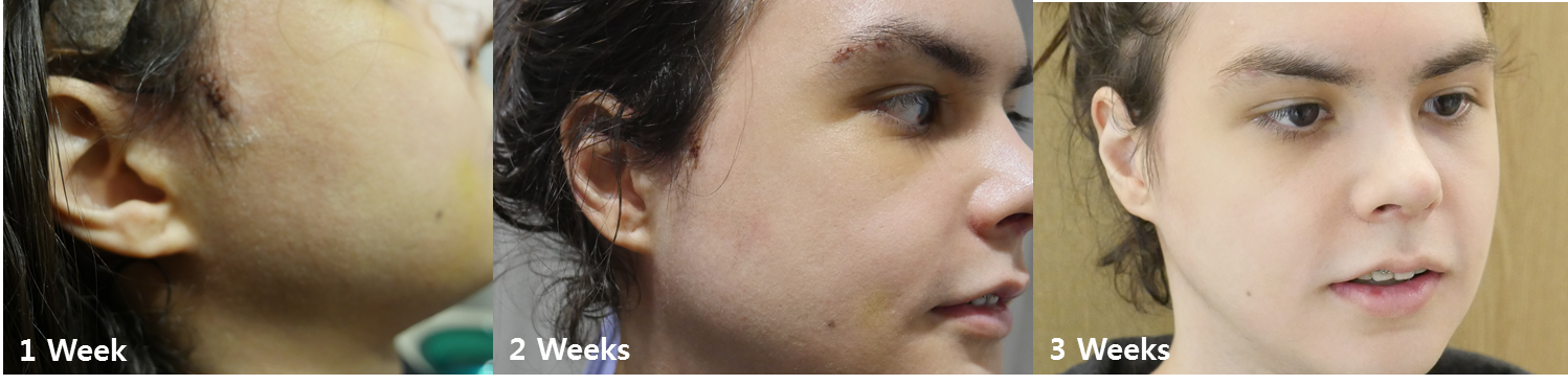 Post-surgery scars: Surgical incision areas and healing scars