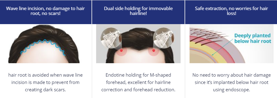 Forehead Reduction Surgery(Scalp advancement) - IDHOSPITAL