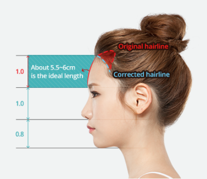 Forehead Reduction Surgery(Scalp advancement) - IDHOSPITAL