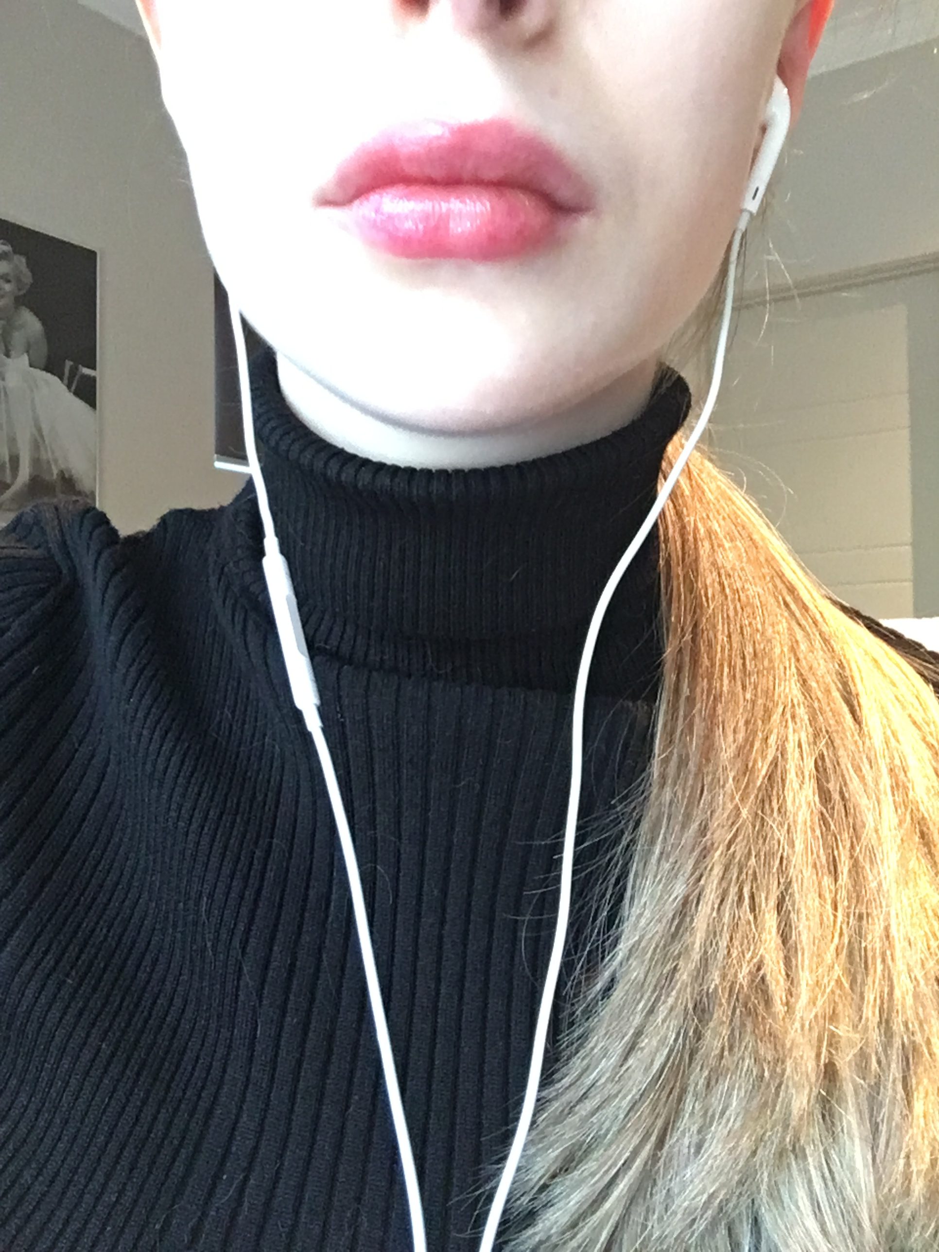 Surgery for mouth protrusion and mini v line surgery – IDHOSPITAL