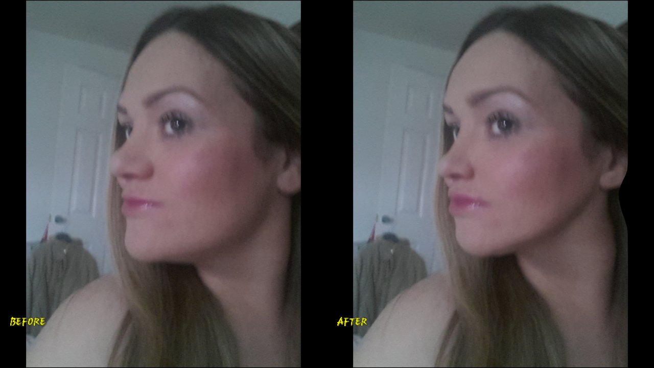 jaw surgery..forehead augment and barbie nose – IDHOSPITAL